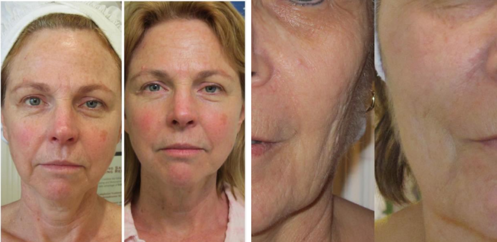 Microneedling – Face ArtWerx